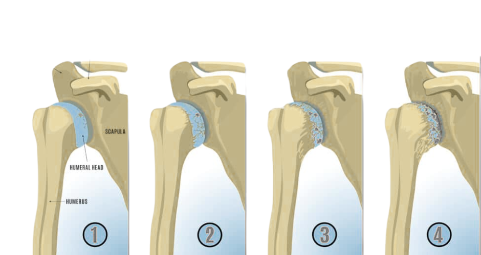 Frozen Shoulder in Adults 40+: Stages, Causes & Best Treatment Options ...